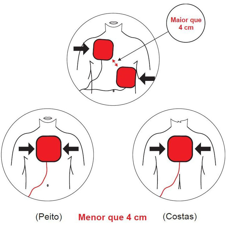 Eletrodo tipo pá Infantil para DEA Desfibrilador Cardioversor Original Instramed